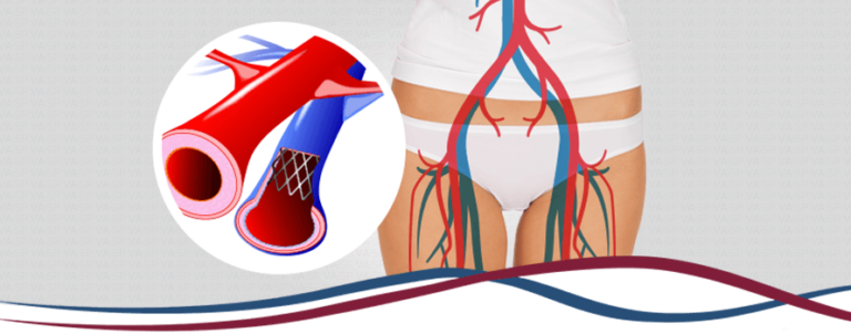 Síndrome de Cockett: Entenda o Que é Esta Condição e Como Tratar ...